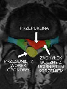Zachyłek boczny kanału kręgowego » Andrzej Kroszczyński