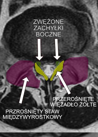 Zachyłek boczny kanału kręgowego » Andrzej Kroszczyński
