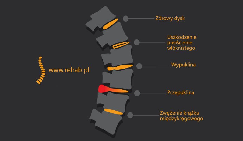 Dyskopatia kręgosłupa – objawy, leczenie, rehabilitacja » Andrzej ...