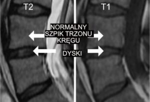 Zmiany zwyrodnieniowe typu Modic 1,2,3 » Andrzej Kroszczyński