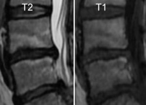 Zmiany zwyrodnieniowe typu Modic 1,2,3 » Andrzej Kroszczyński
