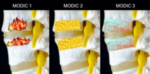 Zmiany zwyrodnieniowe typu Modic 1,2,3 » Andrzej Kroszczyński